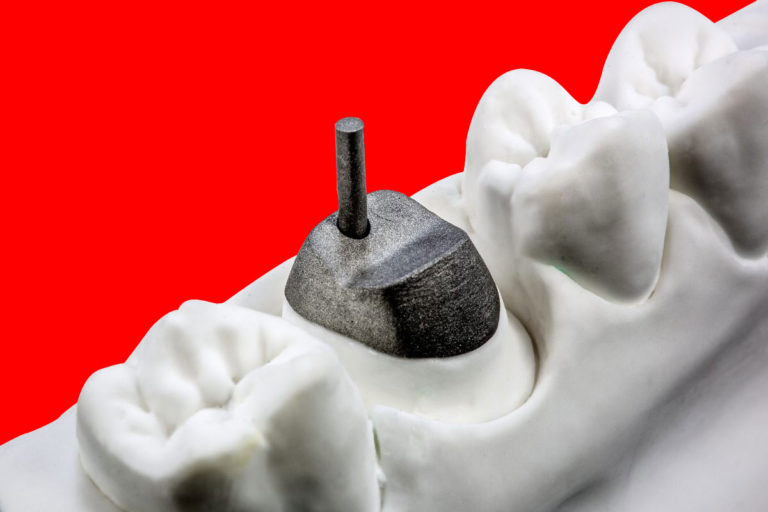 Inlay core métal - Cosmident